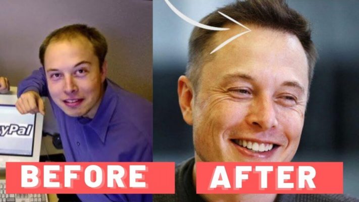 Was Elon Musk Bald? How did Elon Musk grow his hair back? – Belgeard.com
